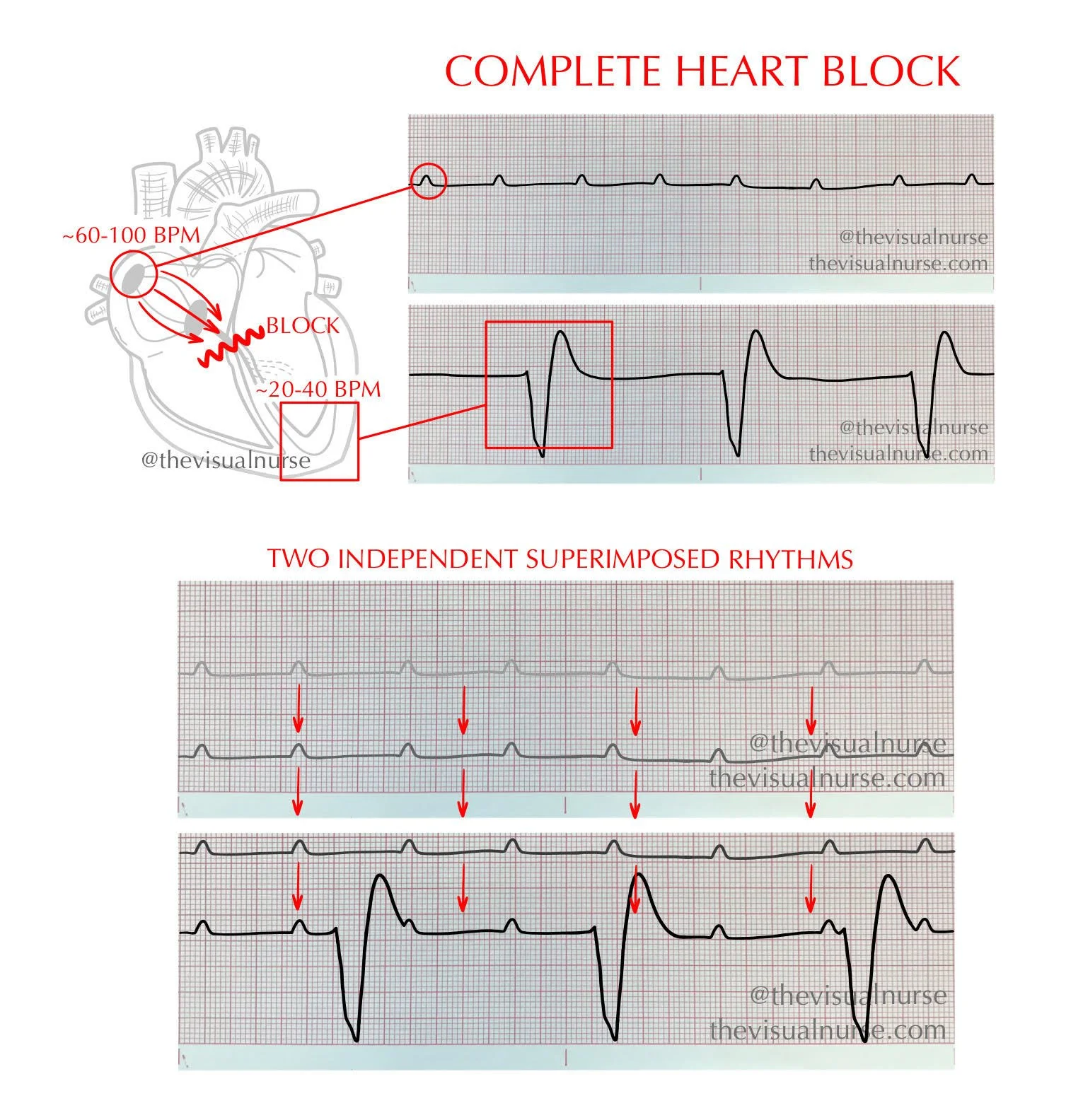 Heart rhythm problems (Cardiac arrythmias) – Mission Healthy Hearts